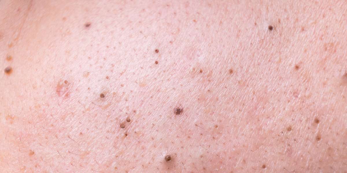 Como Tirar Pontos Pretos de Forma Eficaz: Dicas Caseiras - Jornal de ...